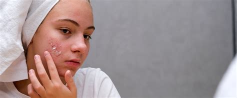Mupirocin Ointment Uses Is It Right For Your Skin Issue