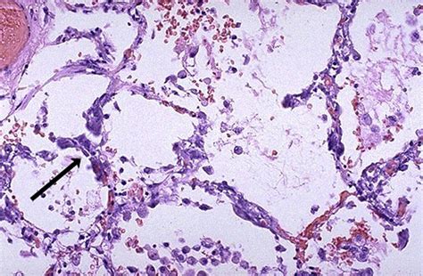 Image 26 Metastatic Calcification Lung