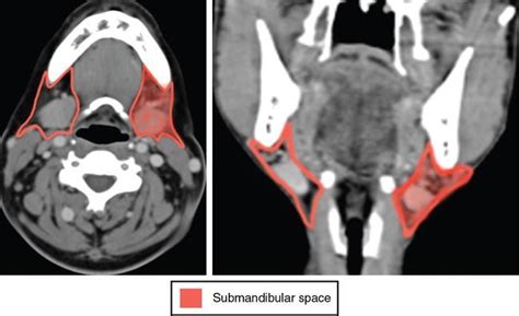 Overview Of Head And Neck Imaging Anatomy Radiology Key