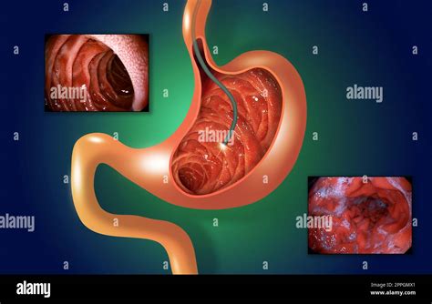 What Is Gastroscopy And Endoscopy At Colin Jetton Blog What Is Gastroscopy And Endoscopy At Colin Jetton Blog