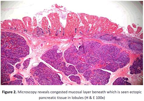 Heterotopic Pancreas Presenting With Intussusception A Rare Case Report Insight Medical
