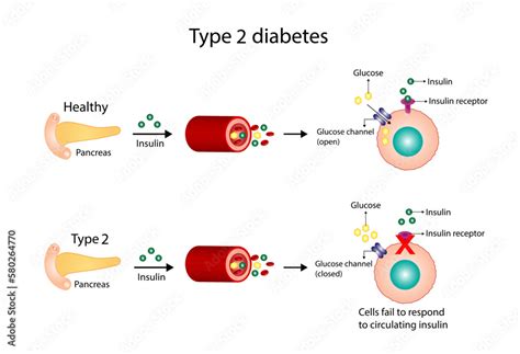 Diabetes Mellitus Insulin Levels Quqk