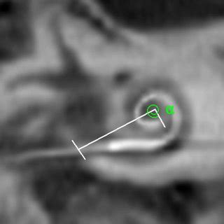Method For The Insertion Depth Angle IDA Measurement Starting Point Download Scientific