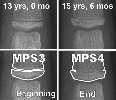 case 3 a the mpm recordings with corresponding ages and according to