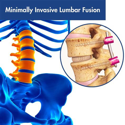 Posterior Lumbar Fusion Recovery Time Yofu