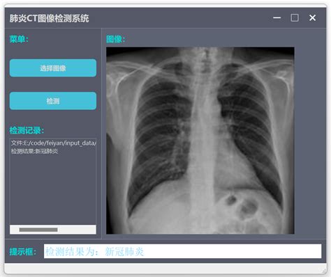 基于深度学习resnetvgg肺炎ct图像检测诊断系统ui界面 索炜达猿创