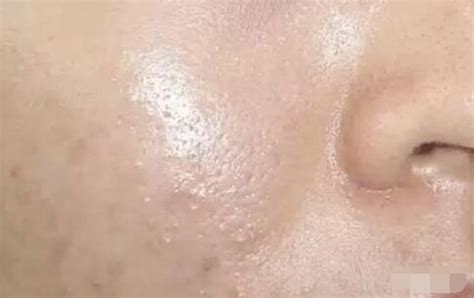壹知肤：油皮就别玩儿命保湿了， 夏季油皮护肤全攻略凤凰网