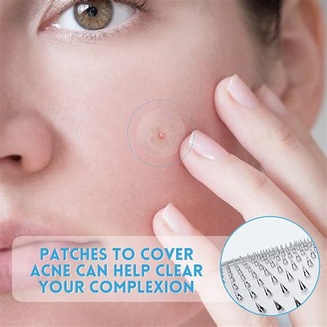 Microneedle Acne Patch Fast Healing And Waterproof Treatment
