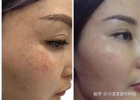 超皮秒后怎么护理、做完皮秒后的注意事项要点分析~ 知乎