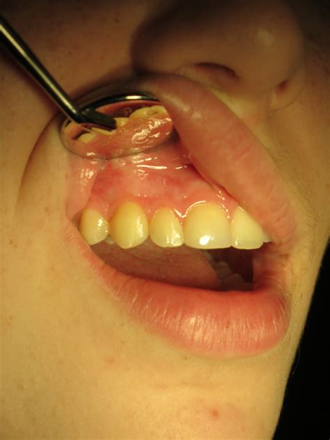 Cuspid Teeth Impaction At Esther Parr Blog