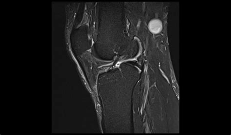 Chondromalacia Mri Radiology Article On Chondromalacia Patellae
