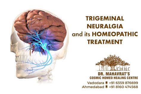 Trigeminal Neuralgia And Its Homeopathic Treatment