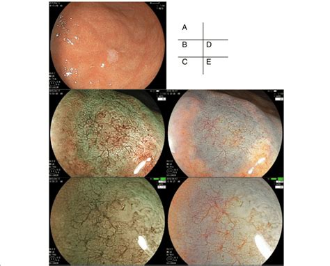 Endoscopic Imaging Findings At Angus Champion Blog