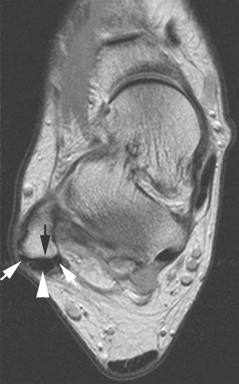 Peroneal Tendon Subluxation Mri