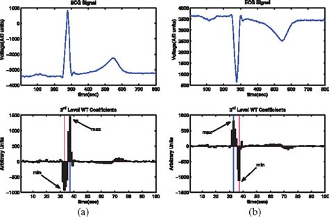 Figure 5 From A Low Complexity Ecg Feature Extraction Algorithm For