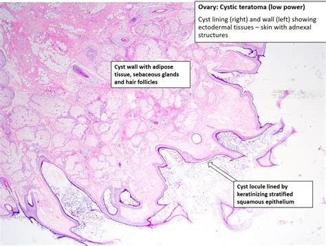 Ovary Cystic Teratoma Nus Pathweb Nus Pathweb