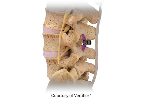 Vertiflex Procedure Coastal Health