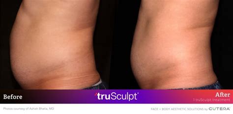 Trusculpt Id Before And After Photos Kansas City Kansas