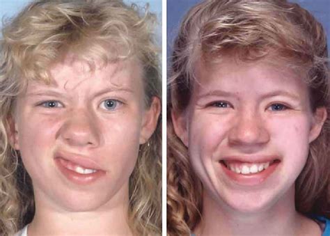 Face Paralysis After Dental Work