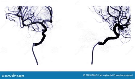Cerebral Angiography Image From Fluoroscopy In Intervention Radiology