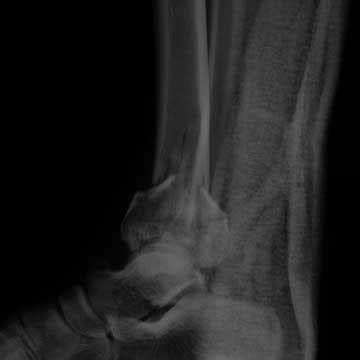 Pilon Fracture ORIF Ex Fix 27828 EORIF