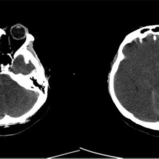 On The Fifth Day Of Admission CT Of The Head Showed That Diffuse Download Scientific Diagram