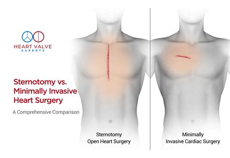 Sternotomy Vs Minimally Invasive Heart Surgery Key Differences