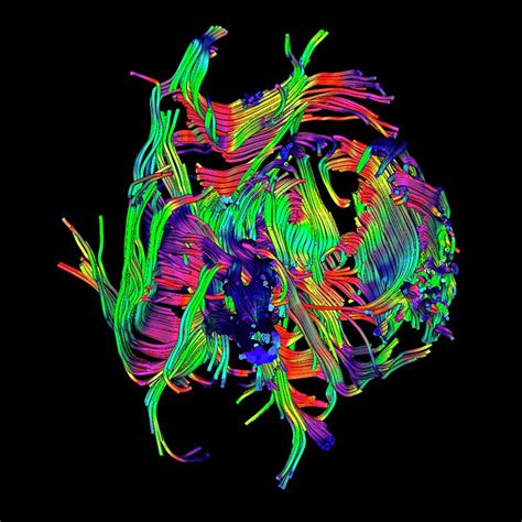 Brain Tumour Photograph By Simon Fraser Science Photo Library Fine Art America