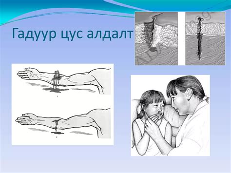 цус алдалтын үед авах арга хэмжээ Pdf