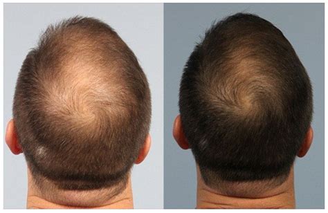 Prp Injection Before And After Platelet Rich Plasma Reviews