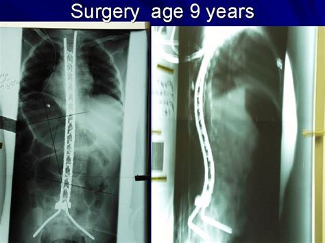 Growing Segmental Spinal Instrumentation Without Fusion In Spinal Growing Segmental Spinal Instrumentation Without Fusion In Spinal