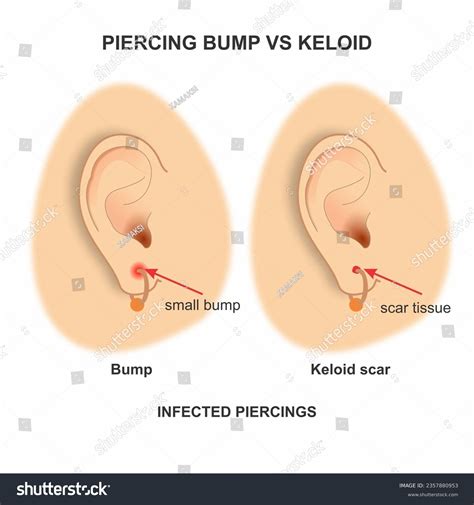 Piercing Bump Vs Keloid Illustration Ear Stock Illustration 2357880953