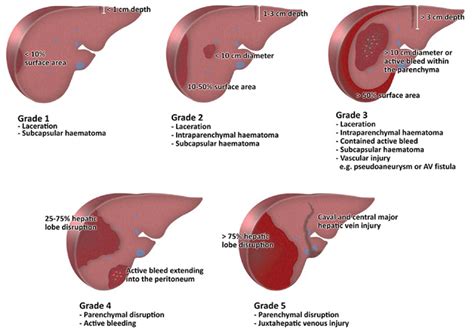 Contemporary Management Of Hepatic Trauma What Irs Need To Know Pmc