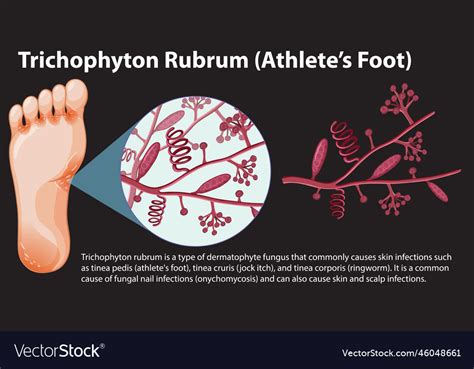 Trichophyton Rubrum Fungal Infection Royalty Free Vector