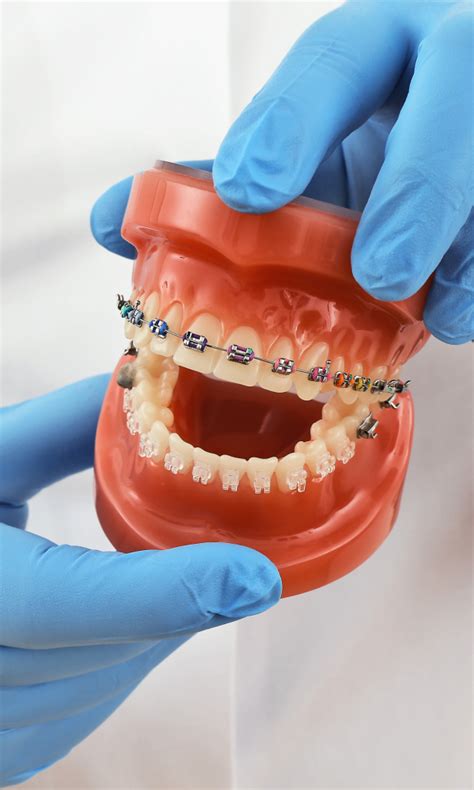 ¿qué Alimentos Comer Con Brackets Clínica Kranion