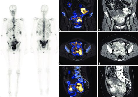 Technetium Uses In Medicine