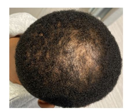 Case Series Highlights Features Of 3 Male Patients With Ccca — Donovan Hair Clinic