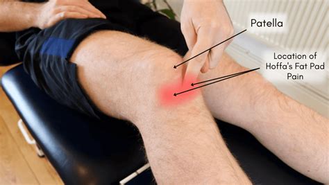 Hoffas Fat Pad Symptoms Diagnosis And Treatment