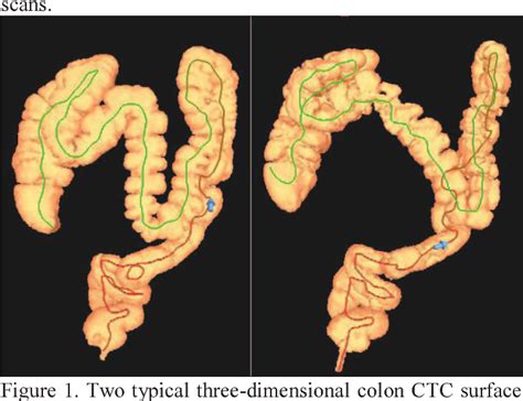 Figure 1 From Centerline Registration Of Prone And Supine Ct Colonography Scans Based On