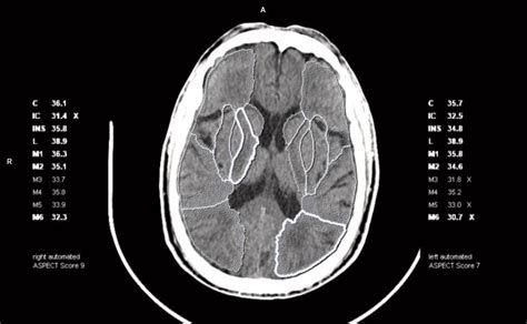 Stroke Imaging Stroke Imaging