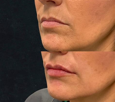 Thin Lips Causes And Treatment