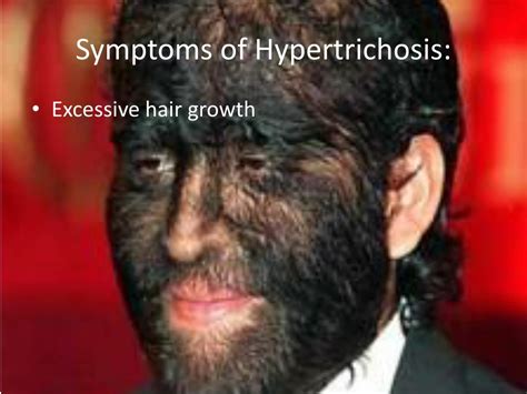 Ppt Hirsutism Hypertrichosis Public Service Announcement Powerpoint