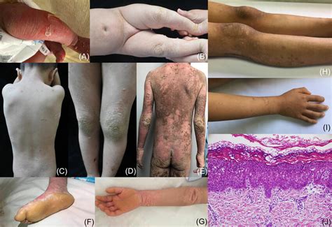 Epidermolytic Ichthyosis Epidermolytic Hyperkeratosis Treatment