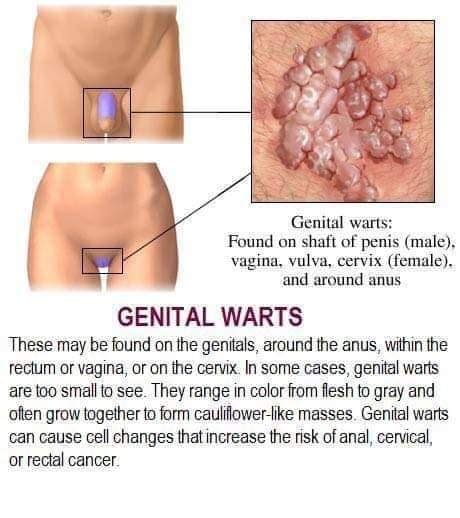 Flexzy Gist Media Genital Warts Genital Warts Are Contagious Fleshy