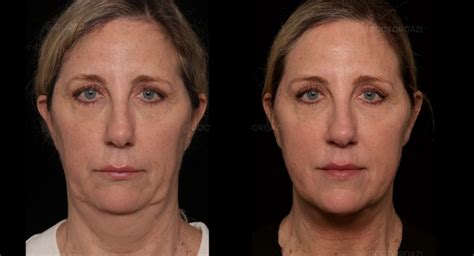 Procedimiento De Facetite ¿qué Esperar Después Del Tratamiento