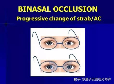 部分调节性内斜视的治疗 知乎