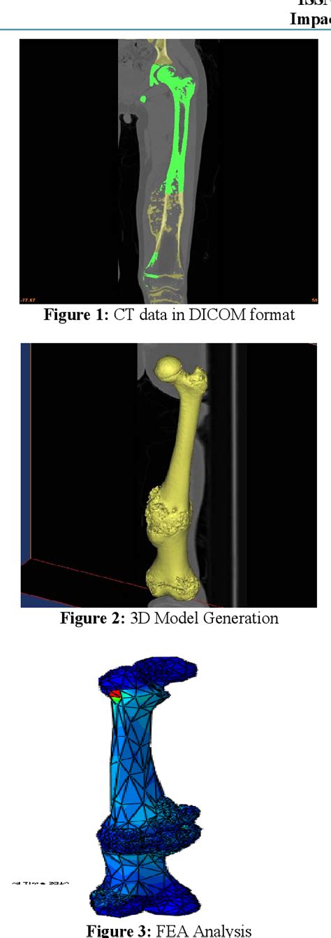 Figure 1 From Application Of Finite Element Analysis To Assess Bone Strength Of Patient Specific