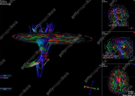 Tractography Dti Diffusion Tensor Imaging Mri Of The Brain 이미지 177844800 게티이미지뱅크