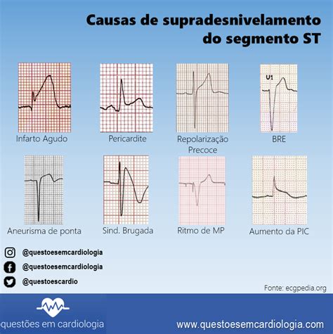 Causas De Supradesnivelamento Do Segmento St