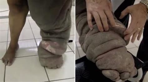 Elephantiasis Is Caused By